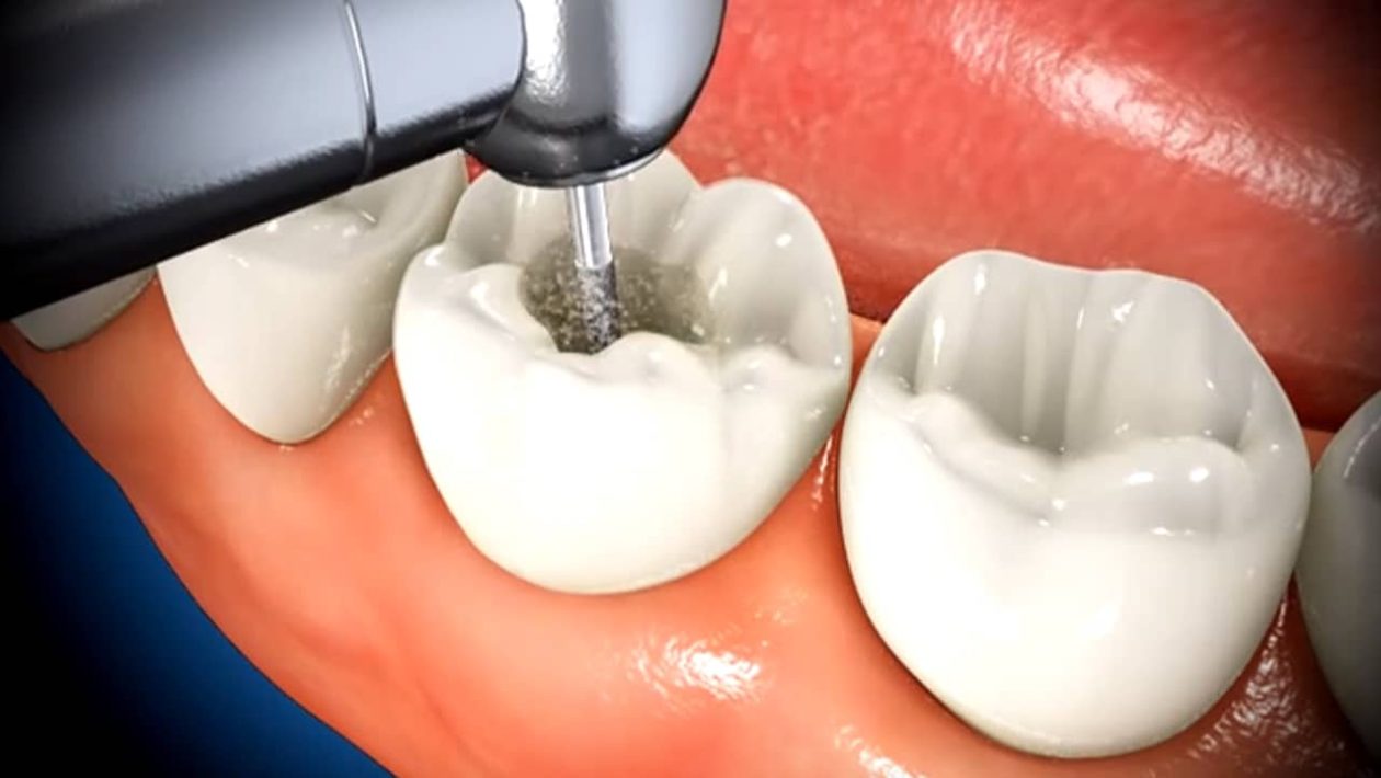 How is the 5-step frontal tooth root canal procedure done? - He and She ...